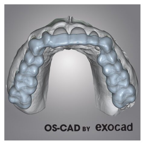 Bite splint OS-CAD by exocad | Opera System