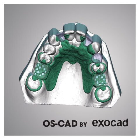 Partial Frameworks OS-CAD by exocad | Opera System